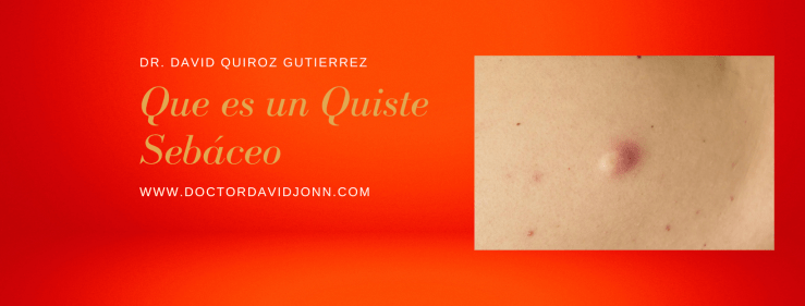¿Qué es un quiste sebáceo? – Dr. David Quiroz